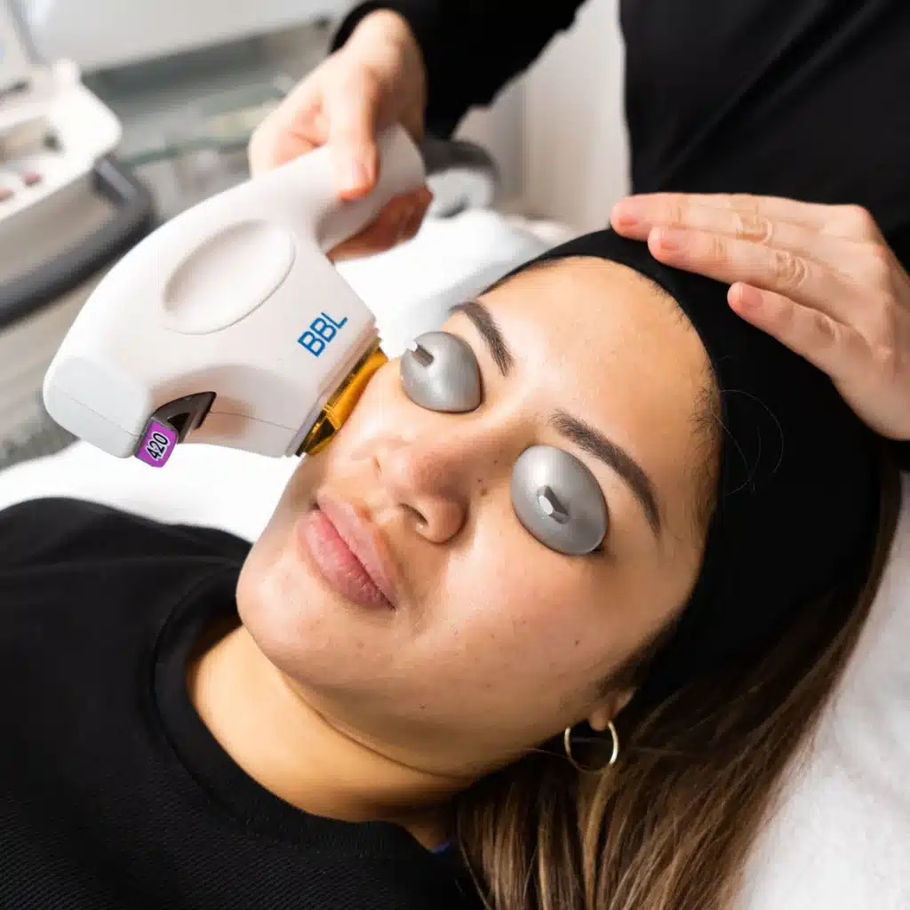 BroadBand Light (BBL™) in Minneapolis & Edina, MN